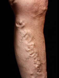 Laser Vascular Center | Vein & Vascular Surgeon Phoenix AZ