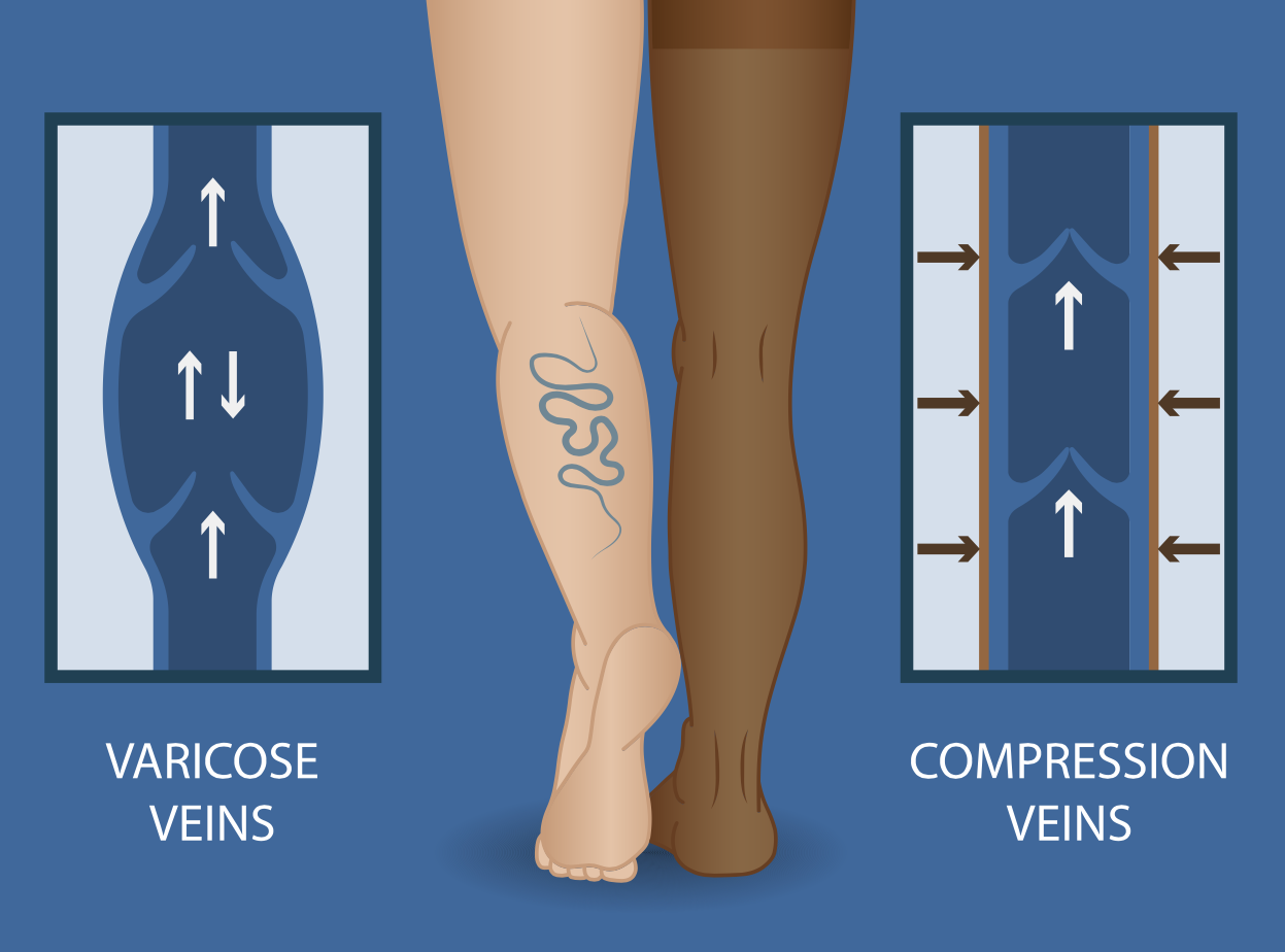 Varicose Veins Treatment In Phoenix AZ Laser Vascular Center