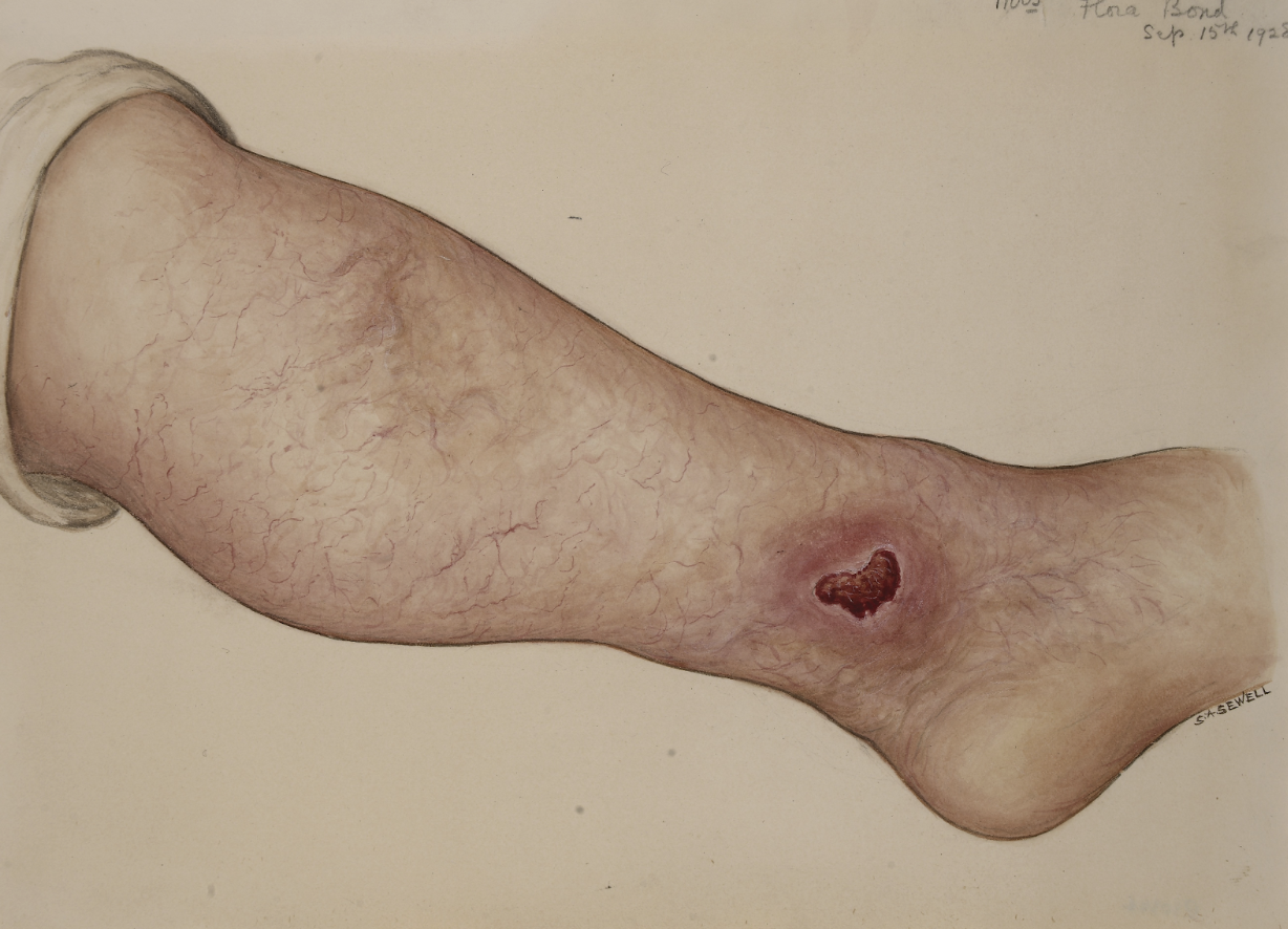 Navigating the World of Skin Ulcers: Understanding, Prevention, and ...