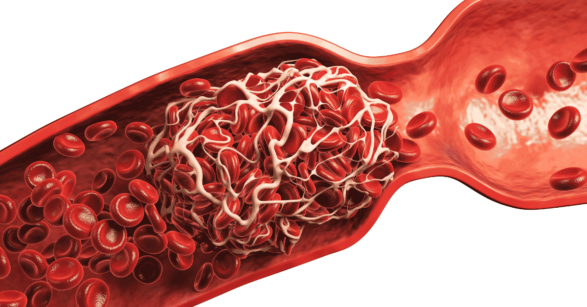 The Hidden Dangers of Ignoring Peripheral Artery Disease (PAD) - Laser ...